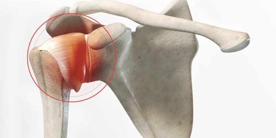 La capsulite rétractile de l'épaule - Douleur à l'épaule